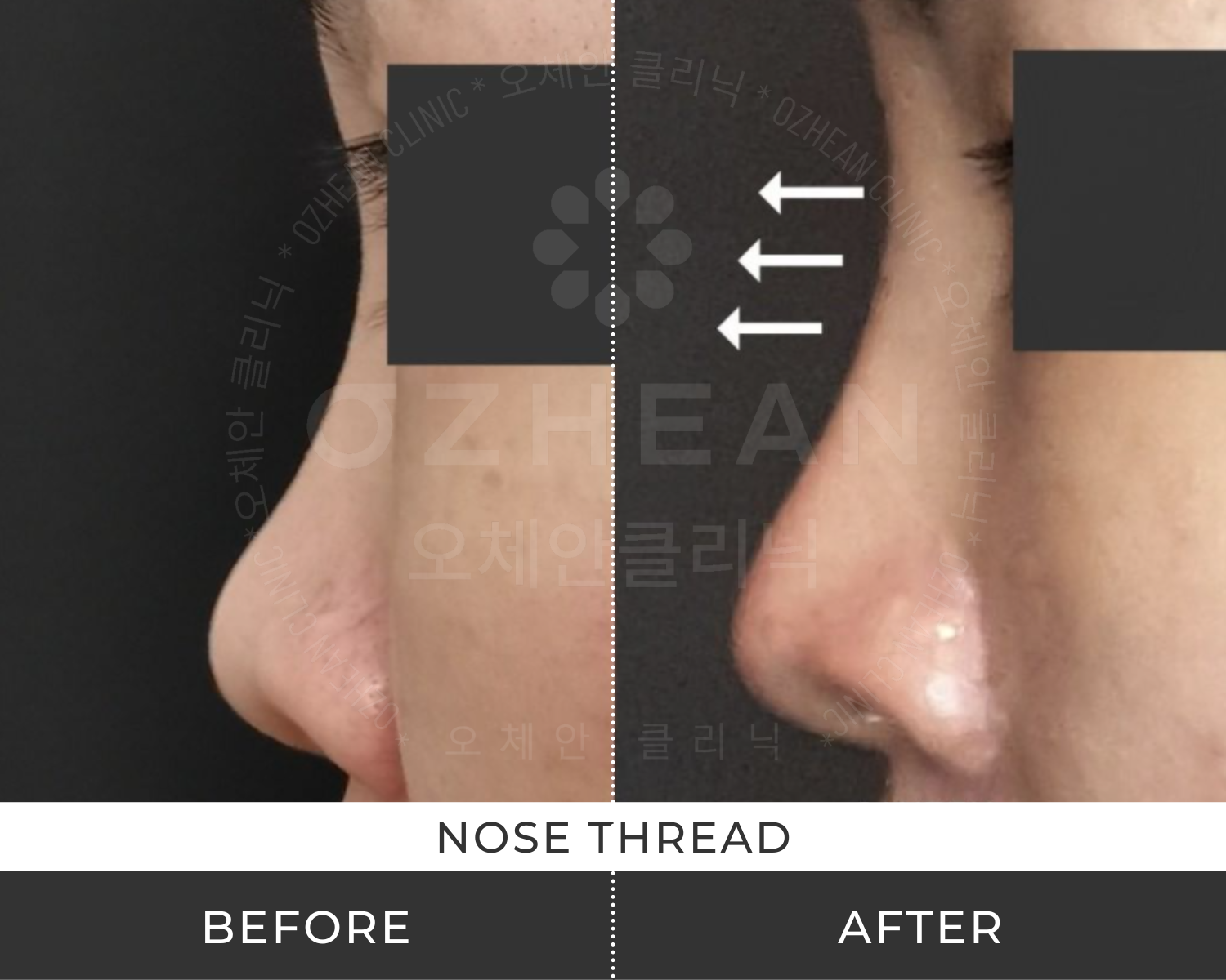 Nose Thread - Perfect Side Profile - Ozhean