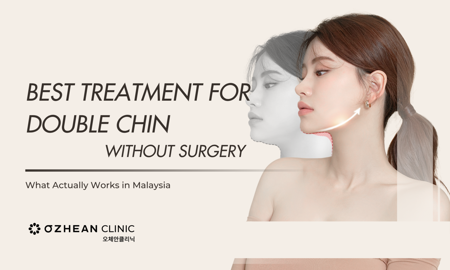 Best Treatment for Double Chin Without Surgery